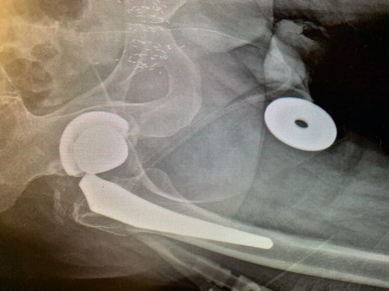 Case Study: Revision Hip Replacement for Fractured Implant