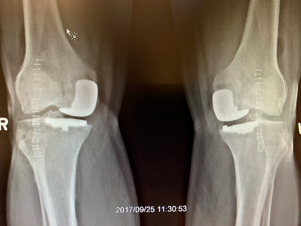 Case Study: Bilateral Knee replacement in 67 yr. Old Male