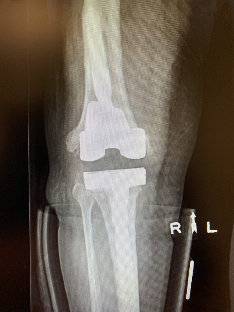 Case Study: Treatment of Knee Replacement in 64 yr. Old Male