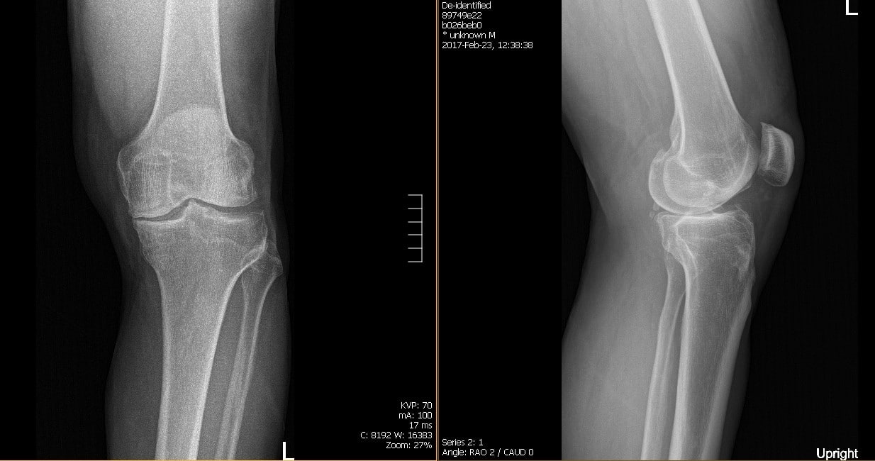 Case Study: Left Total Knee Arthroplasty in 66 yr. Old Male