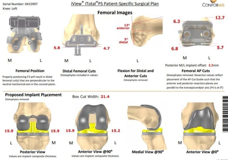 Case Study: Left Total Knee Arthroplasty in 66 yr. Old Male