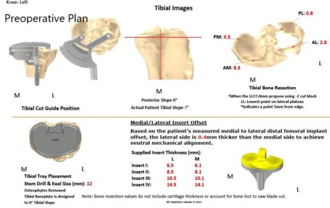 Case Study: Custom Total Left Knee Replacement in Arthritis