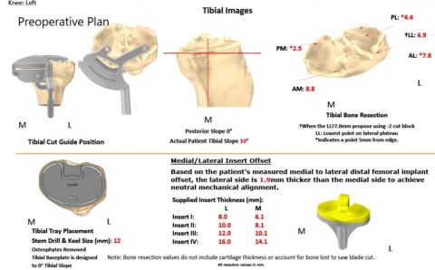 Case Study: Custom Left Knee Replacement in 73 yr. Old Male