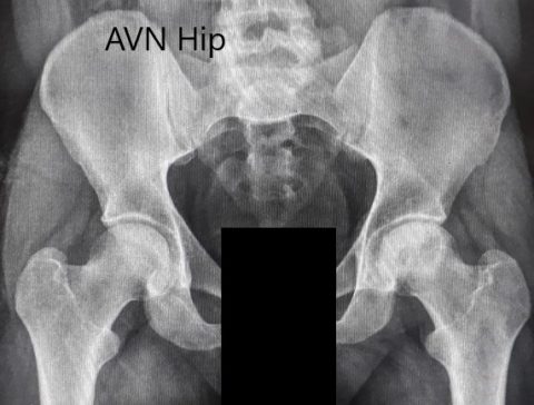 Case Study: Left Hip Total Replacement in 55 Year Old Male