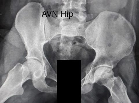 Case Study: Left Hip Total Replacement in 55 Year Old Male