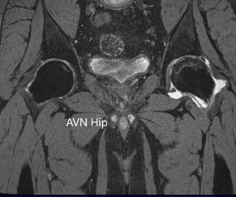 Case Study: Left Hip Total Replacement in 55 Year Old Male