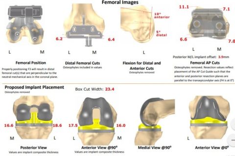 Case Study: Right Total Knee Arthroplasty in 51 yr. Old Male