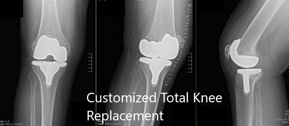 Case Study: Right Total Knee Arthroplasty in 51 yr. Old Male
