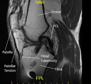 Case Study: Chondroplasty of Left Knee in 63 yr. Old Female