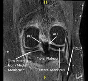 Case Study: Endobutton and Chondroplasty of Left Knee