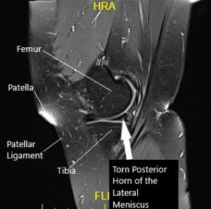 Case Study: Meniscectomy and Chondroplasty of Left Knee