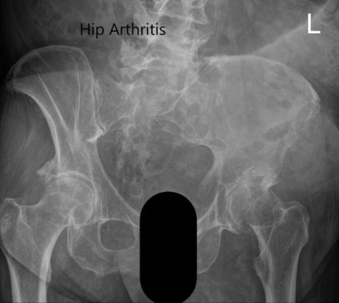 Case Study: Left Total Hip Replacement in 77 yr. Old Female