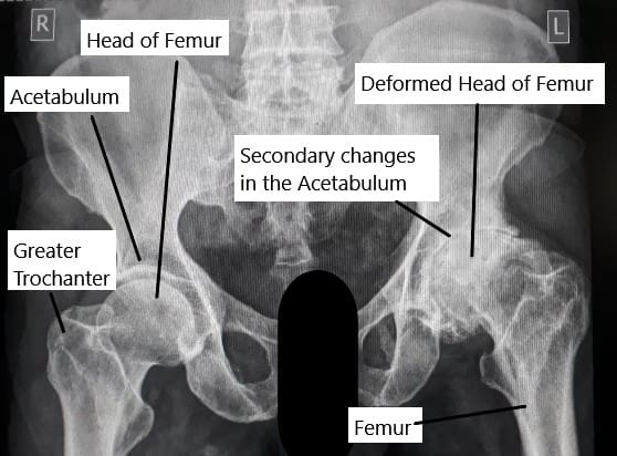 Hip Avascular Necrosis Osteonecrosis In NYC Complete Orthopedics Hip Avascular Necrosis Osteonecrosis In NYC Complete Orthopedics