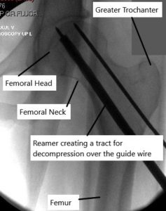 Core Decompression for Avascular Necrosis of Hip | Complete Orthopedics