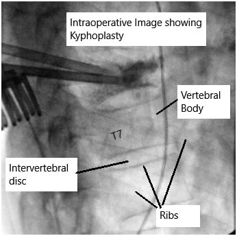 Kyphoplast New York | Minimal Invasive Spine Surgery New York | NY