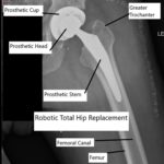Robotic Hip Replacement - Complete Orthopedics & Podiatry
