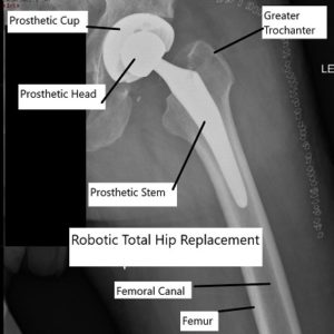 Robotic Hip Replacement - Complete Orthopedics & Podiatry