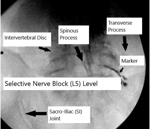 Selective Nerve Root Block - Complete Orthopedics NY