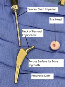 Total Hip Replacement Implants and Surgery | Complete Orthopedics
