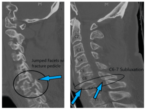 Case Study: Cervical Trauma | Complete Orthopedics