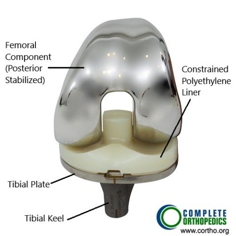 Total Knee Replacement, Knee Specialist in NY | Complete Orthopedics