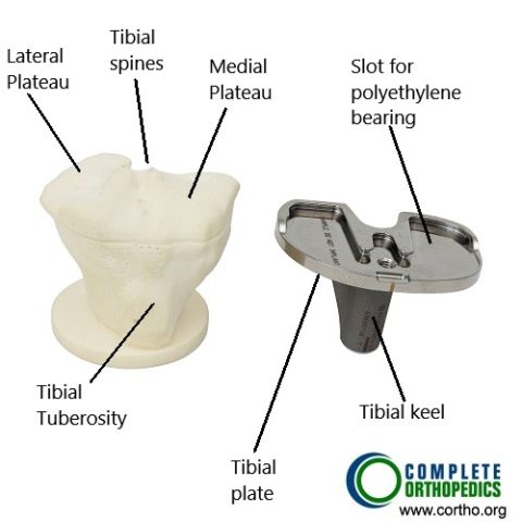 Custom Knee Replacement - Complete Orthopedics & Podiatry