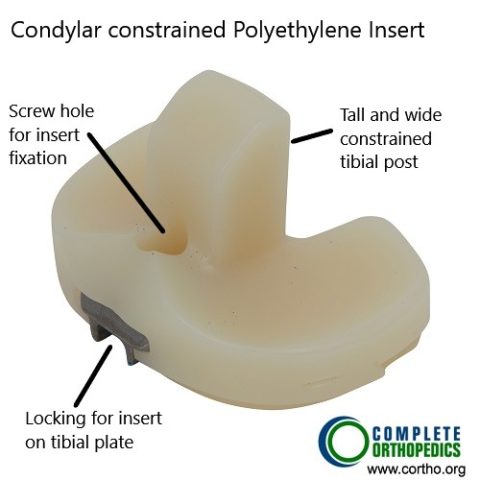 Complex Revision Hip & Knee Joint Replacement New York | Bayside NY