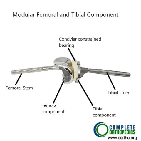 Total Knee Replacement Recovery Guide - Complete Orthopedics