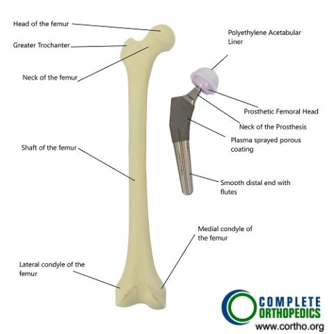 Hip Surgery, Hip Specialist Doctor in New York | Complete Orthopedics