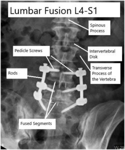 Lumbar Fusion Surgery - Complete Orthopedics & Podiatry