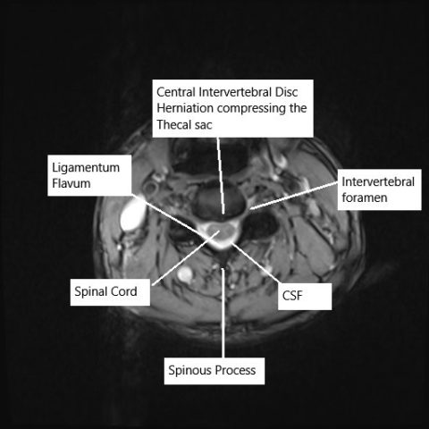 Total Disc Replacement | Spine | Complete Orthopedics