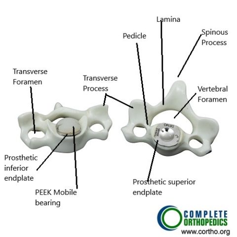 Total Disc Replacement | Spine | Complete Orthopedics