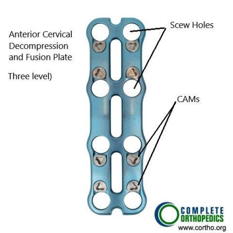 Cervical Degenerative Disk Disease - Complete Orthopedics