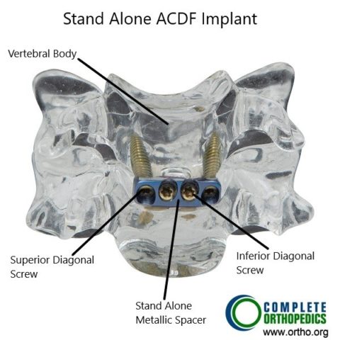 Cervical Spine Fusion - Minimally Invasive - Complete Orthopedics
