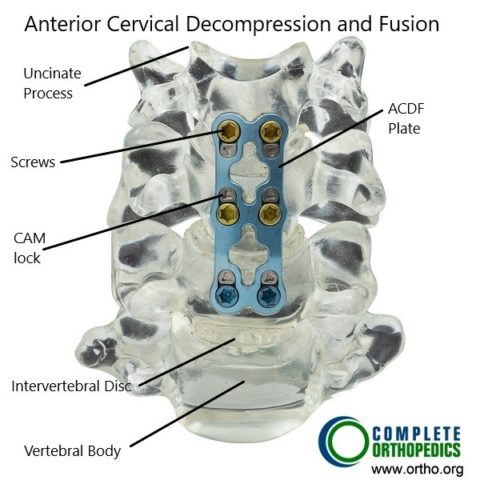 Cervical Spine Fusion - Minimally Invasive - Complete Orthopedics