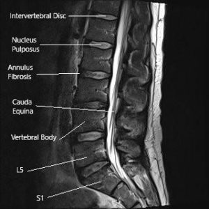 Spine Tumors - Complete Orthopedics & Podiatry | Multiple NY Locations