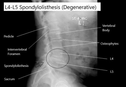 Spondylolisthesis - Complete Orthopedics & Podiatry | Multiple NY Locations