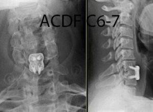 Anterior Cervical Discectomy and Fusion - Complete Orthopedics