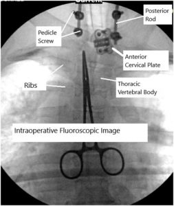 Anterior Cervical & Versus Posterior Surgery - Complete Orthopedics