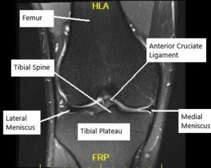 ACL Reconstruction Surgery - Complete Orthopedics
