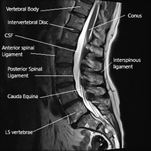 Interspinous Process Spacer - Complete Orthopedics
