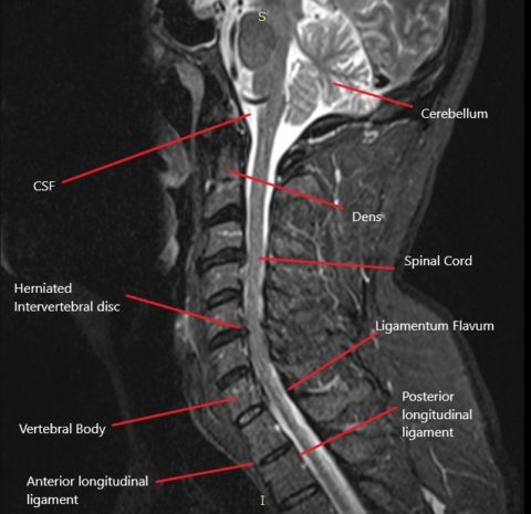 Cervical Microdiscectomy - Complete Orthopedics | Multiple NY Locations