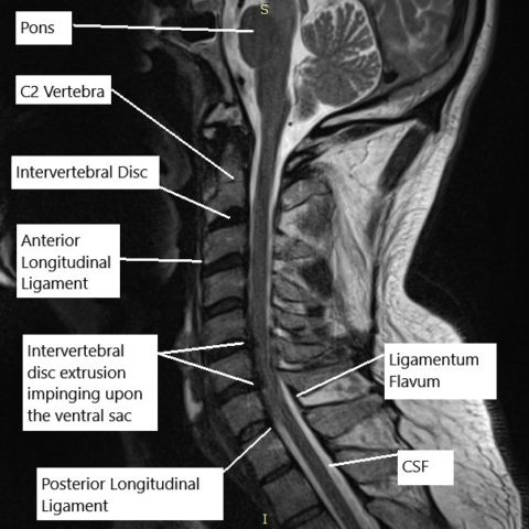 Case Study: Cervical Disc Replacement in 60 yr. Old Female