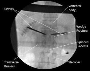 Case Study: Wedge Collapse of L1 Vertebrae in 62 yr. Old Female