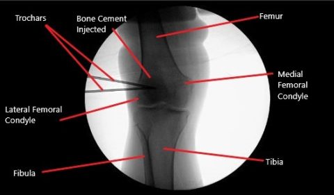 Case Study: Lateral femoral subchondroplasty in 54 yr. Old Male