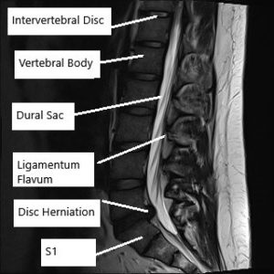 Microdiscectomy Complications Surgery - Complete Orthopedics