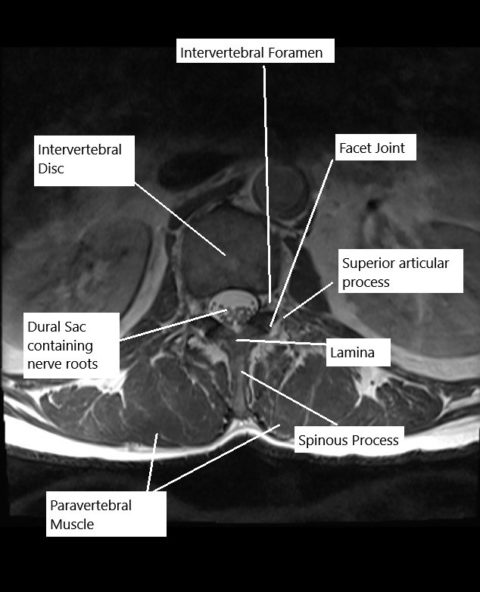Microdiscectomy vs Laminectomy Surgeries - Complete Orthopedics