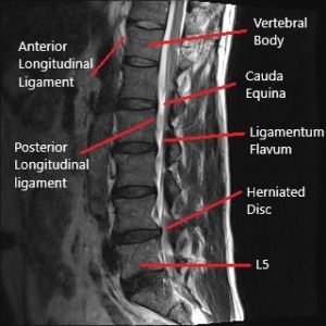 Microdiscectomy vs Nucleoplasty Surgeries - Complete Orthopedics
