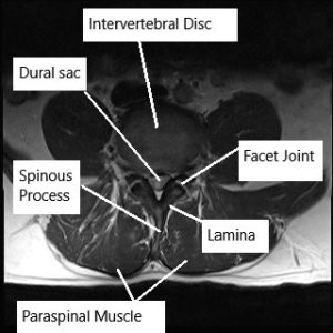 Open discectomy vs Microdiscectomy - Complete Orthopedics
