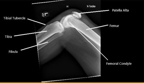 Case Study: Patellar Tendon Rupture in 70 Year Old Male